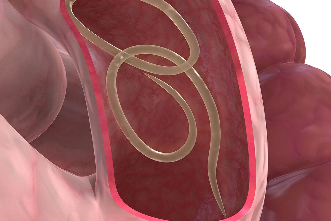 Types of worms in humans, infection, prevention, treatment - Wormin